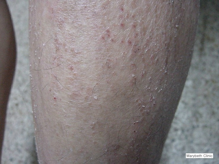 피부질환 백과사전﻿﻿ - 11. 건성습진 (乾性 濕疹, Xerotic eczema) : 네이버 블로그