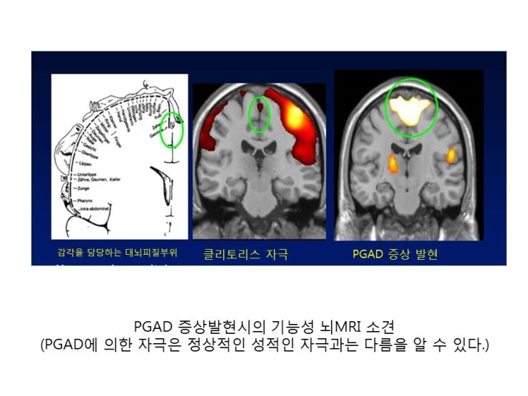 한국인에게서 나타난 지속성성기흥분장애(Persistent Genital Arousal Disorder, PGAD) 의 다양한 ...