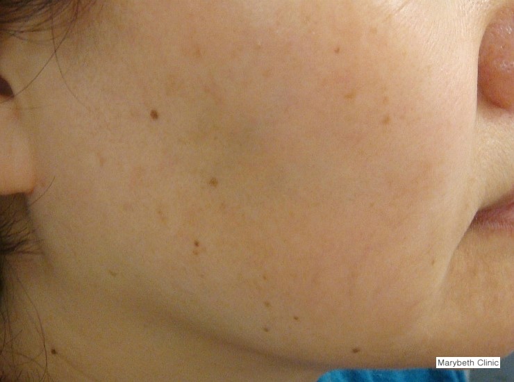 44. 단순흑색점 (단순 흑자, 單純黑子, Lentigo simplex) - 피부질환 백과사전﻿﻿ : 네이버 블로그