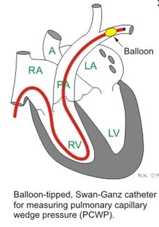 swan ganz catheter : 네이버 블로그