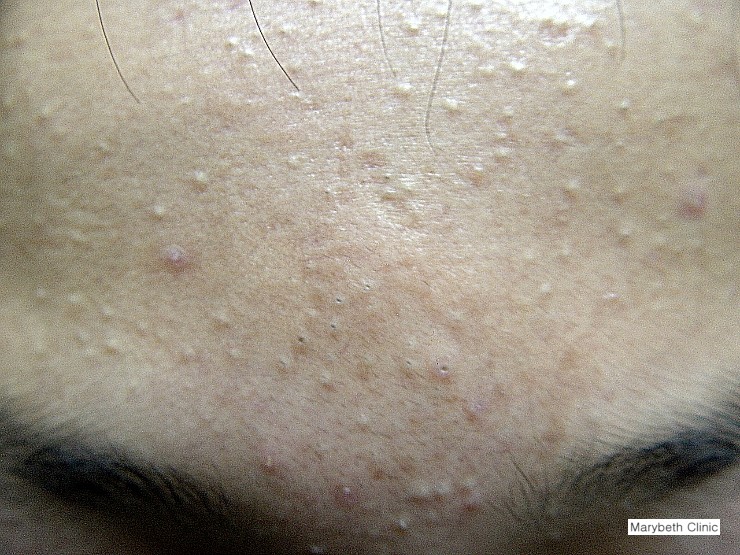 68. 면포여드름 (면포성 여드름, Acne comedonica) - 피부질환 백과사전﻿﻿ : 네이버 블로그