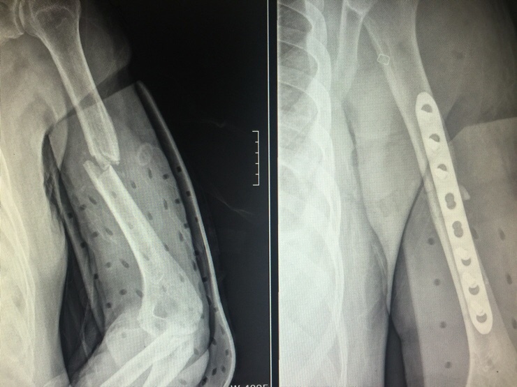 ORIF humerus shaft fracture : 네이버 블로그