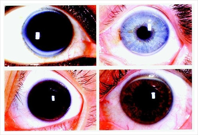 노인환 노년환 각막환 corneal arcus : 네이버 블로그