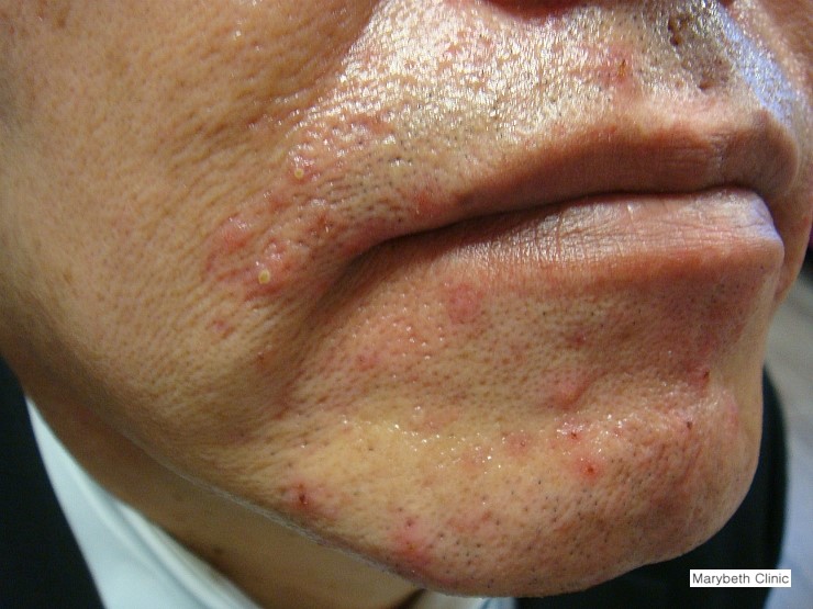 105. 보통털종기증 (심상성 모창, 尋常性 毛瘡, Sycosis vulgaris) - 피부질환 백과사전﻿﻿ : 네이버 블로그