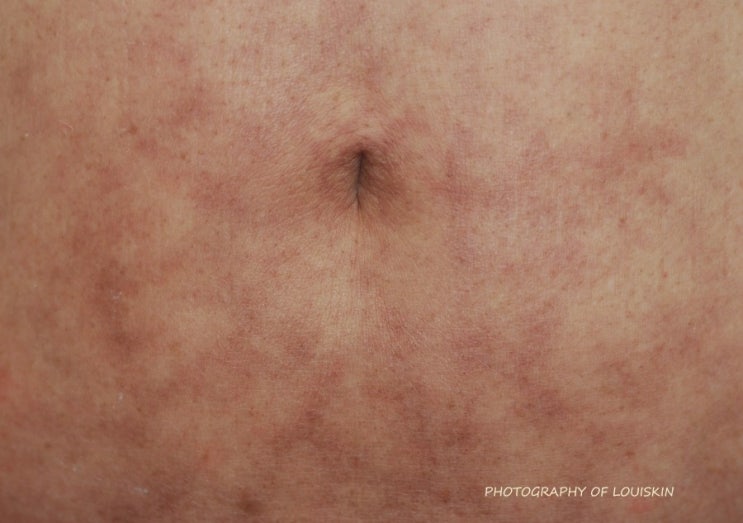 열성 홍반 (Erythema ab igne) 에 대한 기억 : 네이버 블로그