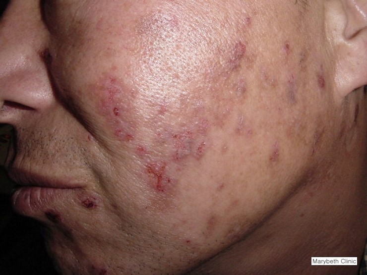 145. 신경긁은상처 (신경증적 찰상, 神經症的 擦傷, Neurotic excoriation) - 피부질환 백과사전 ...