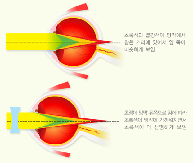 춘천안과 가성근시 소아시력검사 조절마비굴절검사 네이버 블로그