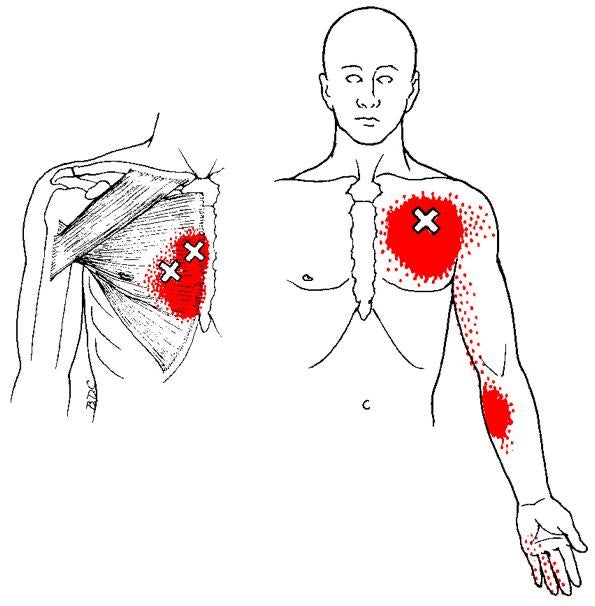 가슴통증을 의심해볼 대흉근과 쇄골하근 Pectorlis Major And Subclavius 흉곽출구증후군의심 네이버 블로그