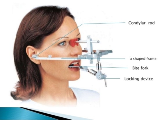 Facebow and Articulator (안궁과 교합기) - 1.Facebow 안궁 : 네이버 블로그