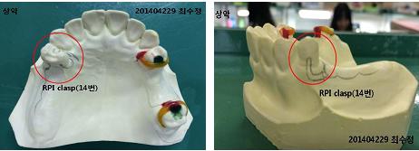 국소의치 실습_RPA clasp Wax-up& RPI clasp 디자인 : 네이버 블로그