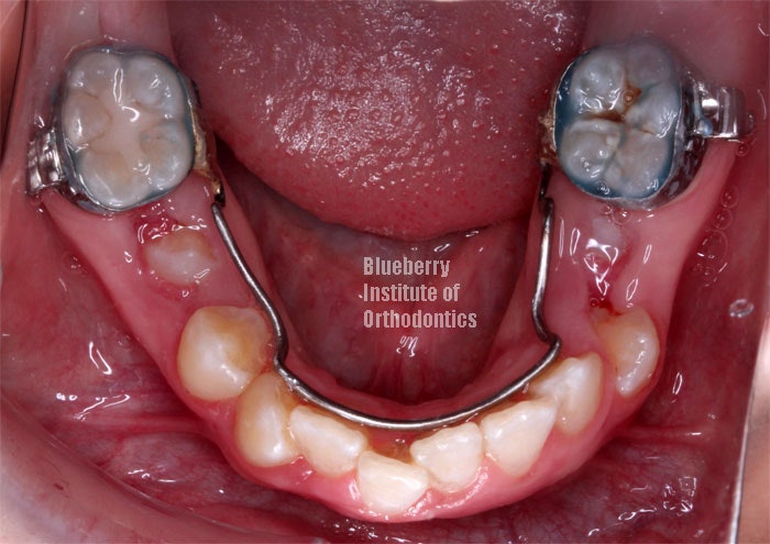 Lingual holding arch 효과 (리뷰 저널) : 네이버 블로그