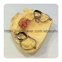 [정관 교정치과] Nance holding arch + Halterman장치에요~ : 네이버 블로그