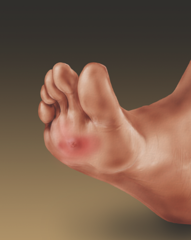 중족골 밑 외막 윤활낭염 - Submetatarsal adventitial bursitis : 네이버 블로그