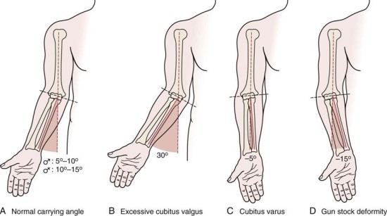 주관절 변형(Elbow deformity) : 팔꿈치가 휜 것 같아요 : 네이버 블로그