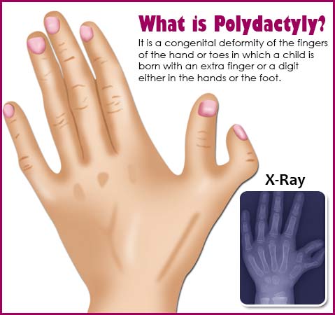 다지증(polydactylism) 발생원인, 유전적 배경, 분류 : 네이버 블로그