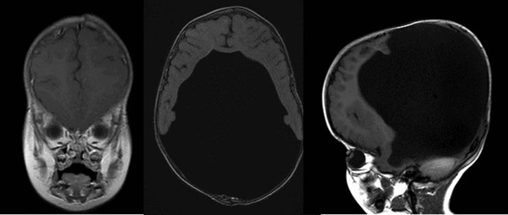 [약혐] 단안증(Cyclopia syndrome) : 네이버 블로그
