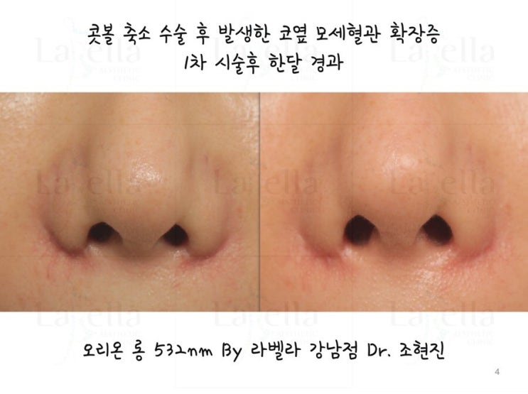 코 옆 실핏줄 제거 코 옆 혈관확장증 치료에 오리온 레이저 네이버 블로그