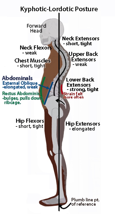 체형분석 3편 - 흉추 후만/요추 전만증 (KYPHOSIS/LORDOSIS POSTURE) : 네이버 블로그