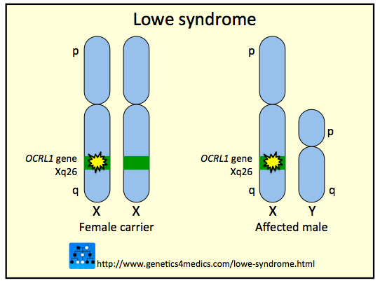 로베 증후군 lowe syndrome : 네이버 블로그