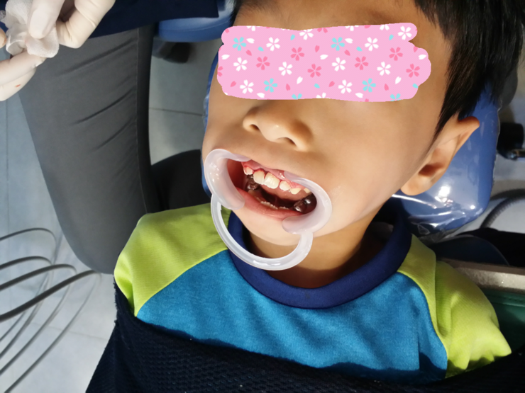 초등학교 2학년 장난꾸러기의 영구치 치아외상치료모습을 함 볼까요 네이버 블로그