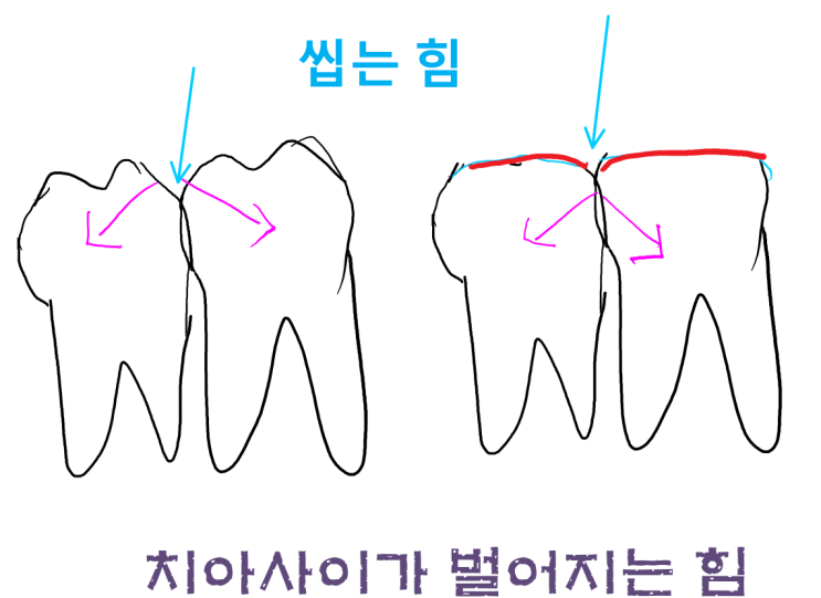 서울덴치과 음식물이 치아사이에 껴요 치아마모가 원인일수 있습니다 네이버 블로그