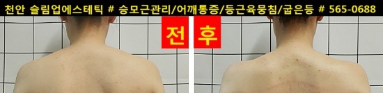 천안어깨결림천안어깨통증 슬림업에스테틱에서 등근육 뭉친어깨 제대로 푸는 승모근관리 네이버 블로그