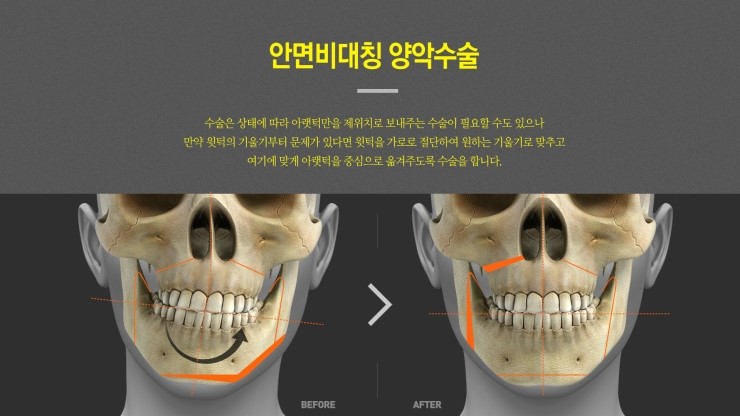 안면비대칭 - IVRO? SSRO? : 네이버 블로그