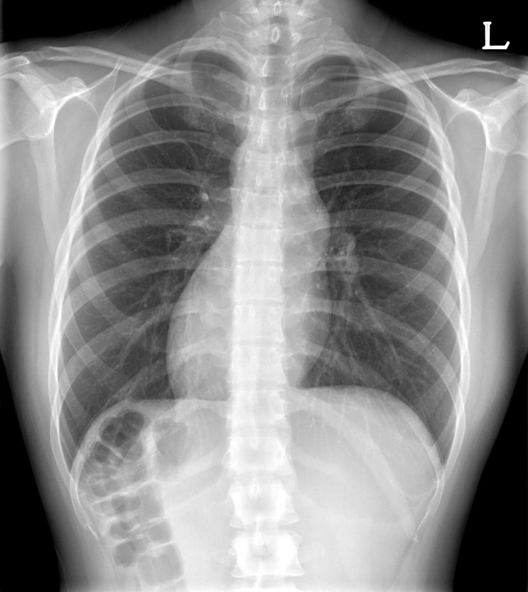 Situs Inversus