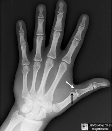 엄지 중수-수지 관절 탈구 및 인대 손상(1st MCP joint dislocation and ligament injury ...