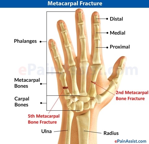 제 2-5 수지 중수골 골절(2nd~5th metacarpal fracture) : 손바닥에 큰 충격을 받고 중수골이 부러졌어요 ...