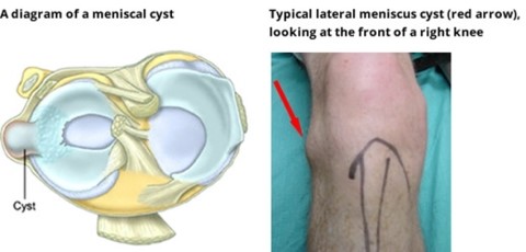 반월상 연골 낭종(Meniscal cyst, Parameniscal cyst) : 무릎 옆쪽에 혹이 생겼어요 : 네이버 블로그
