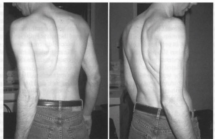 요추 회전신전증후군(lumbar rotation-extension syndrome) : 네이버 블로그