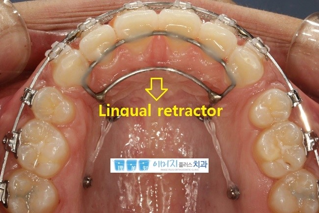 돌출입과 잇몸돌출을 해소해주는 Lingual retractor [부산치아교정전문의] : 네이버 블로그