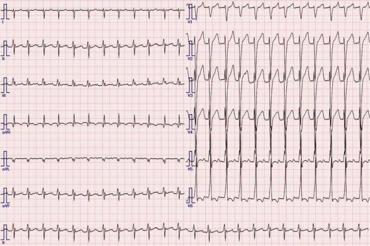 정상 QRS 빈맥의 감별 - PSVT? : 네이버 블로그