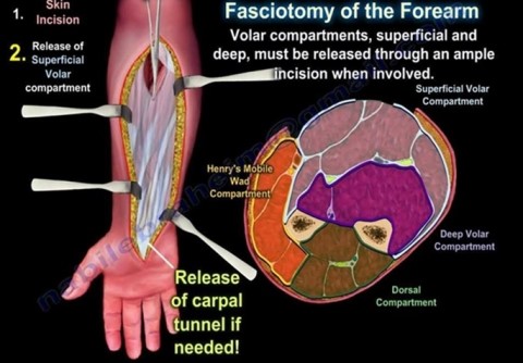 상지 구획증후군(Forearm compartment syndrome) : 팔에 외상을 입은 뒤 무척 강한 통증이 있어요 ...