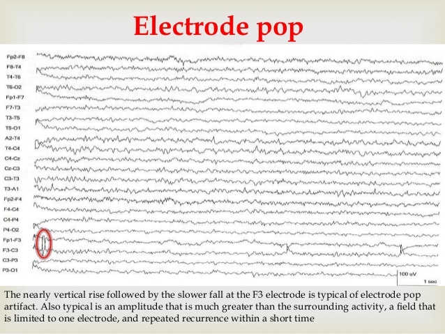 EEG 신호의 결함과 비정상 활동 신호(from Wikipedia) : 네이버 블로그