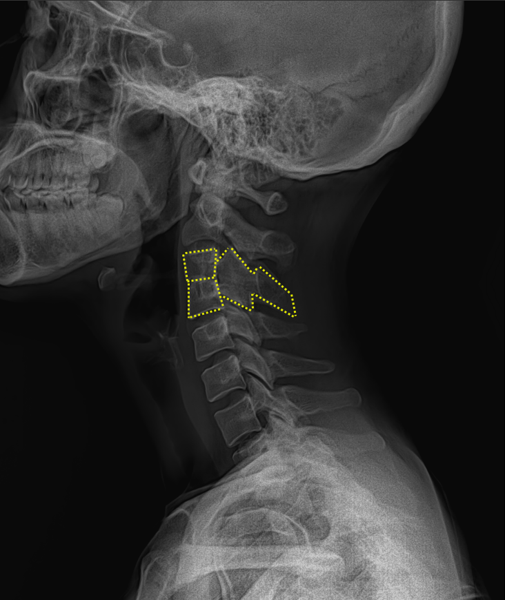 Block Vertebra at C3+C4 : 네이버 블로그