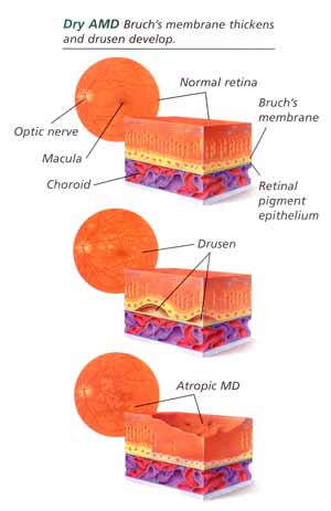 [2부] Chapt. 10. 눈 ,구조와 생리, Dry AMD, Age-related macular degeneration, 시 ...
