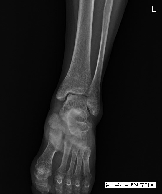 발목 연골 손상에서의 관절경적 미세천공술, 미세골절술(arthroscopic microfracture at ankle ...