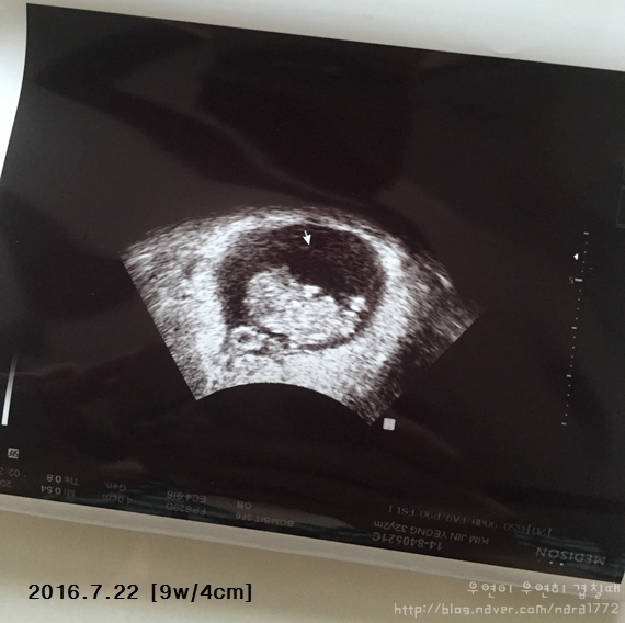 임신 9주차 증상 초음파 젤리곰 은총이 비타민d 검사 임산부 비타민d 효능 임산부 유산균 추천 Vsl3 임신
