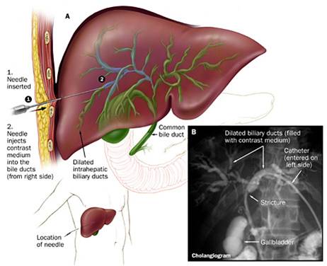 PTBD[Percutaneus transhepatic biliary drainage]경피경간담즙배액술, 폐색성 황달 감황 ...