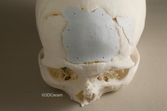 3DCeram 3D Prints Custom-Designed, Biocompatible Cranial Prostheses 리컨 ...