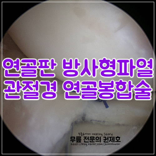 무릎연골판 방사형파열 관절경을 이용한 연골판 봉합술 네이버 블로그