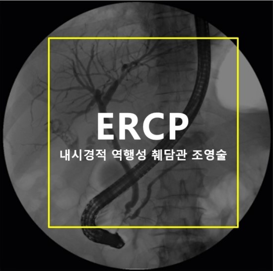 내시경적역행성 췌담관 조영술 [ERCP] : 네이버 블로그