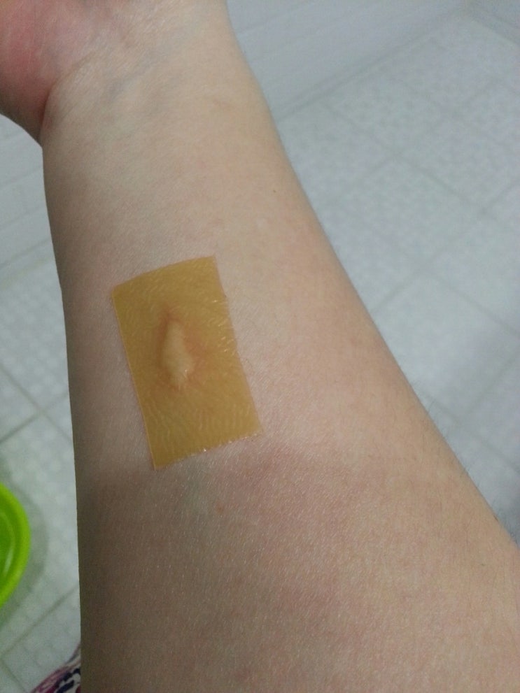 유아 화상치료 표재성 2도화상 치료기 화상전문병원에서 쓰는 습윤드레싱 듀오덤 네이버 블로그