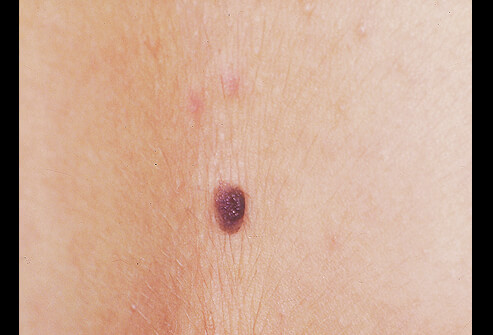 "점에도 종류가 있나요?" 다닥다닥 내 점은 어떤 점?빼면 깨끗이 잘 없어질까? : 네이버 블로그