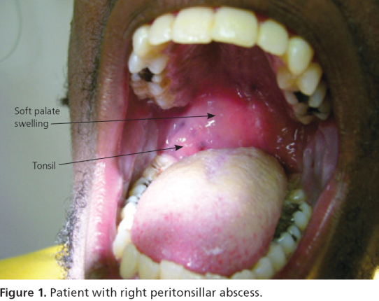 편도주위농양(peritonsillar abscess)[광주주사랑의원] : 네이버 블로그