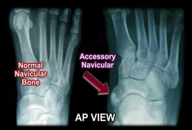 Accessory Navicular