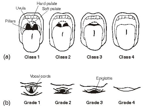 Pharyngeal injection/Pharyngeal tonsilar hypertrophy : 네이버 블로그