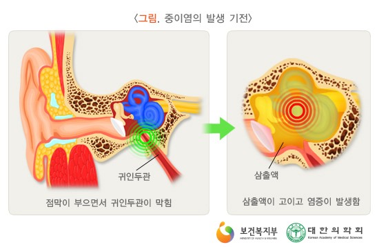 중이염 tympanitis : 네이버 블로그